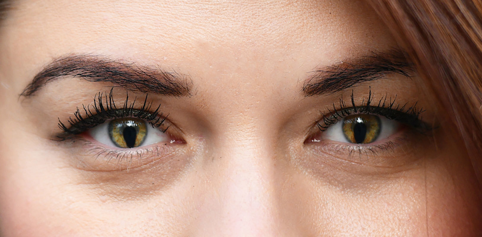 Coloboma Of The Eye