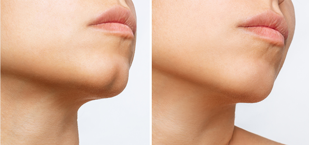 Cleft Chin Myths